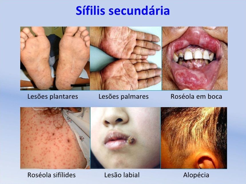 SÍFILIS - Saúde promove campanha de combate e prevenção à sífilis ...